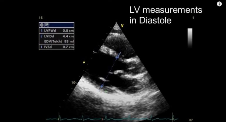 2:36 Now take the same three measurements in systole.