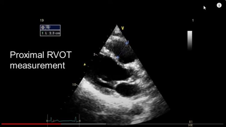 2:42 Zoom aortic valve and