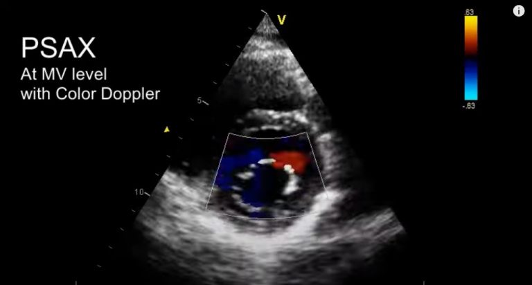 4:34 Now point the beam more apically