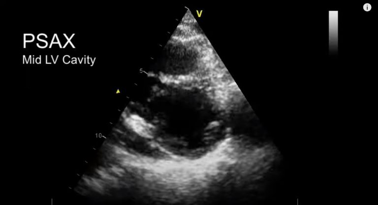 Here is a clearer image of the midcavity from Focused Cardiac ...