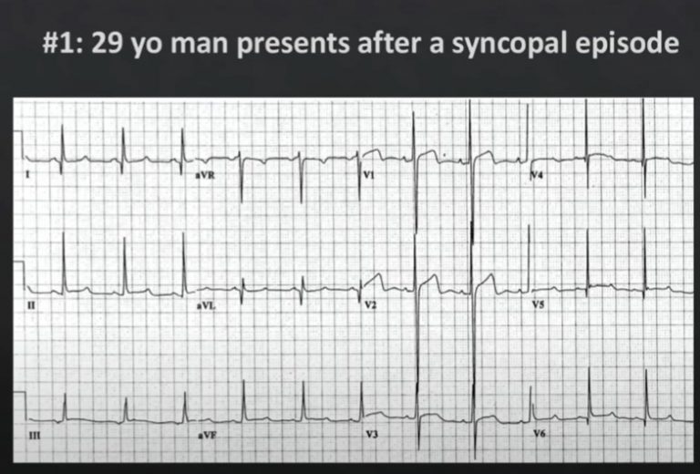 The patient was discharged to home after the above ecg.