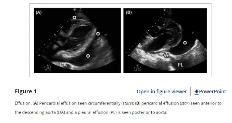 Techniques for Assessing Effusion
