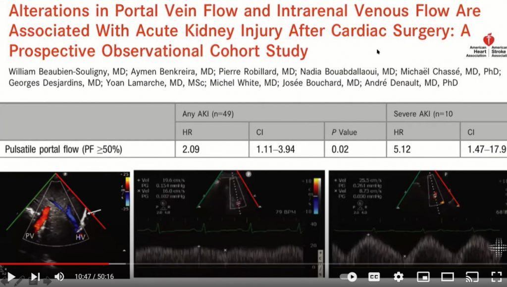 11:35 PF (pulsatility fraction) refers to the Portal Vein Vmax and Vmin
