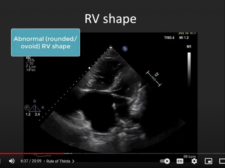 6:45 Parasternal short axis