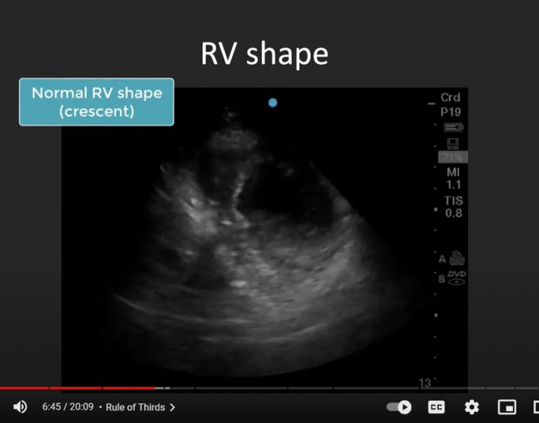 6:57 Parasternal short axis – abnormal