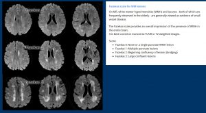 Fazekas Scale For White Matter Lesions