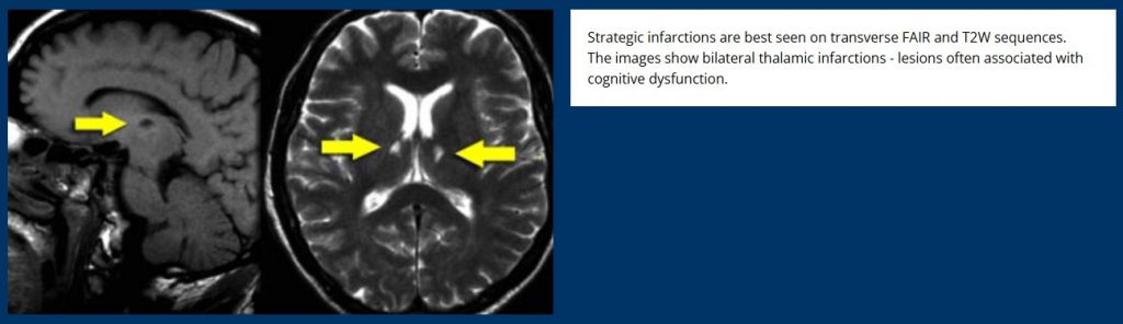 Koedam Score for Parietal Atrophy