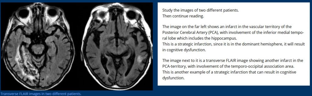 Koedam Score for Parietal Atrophy