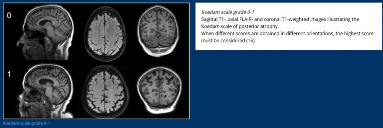 Koedam Scale Grade 2-3