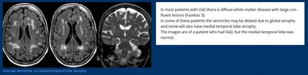 28-Strategic Infarcts