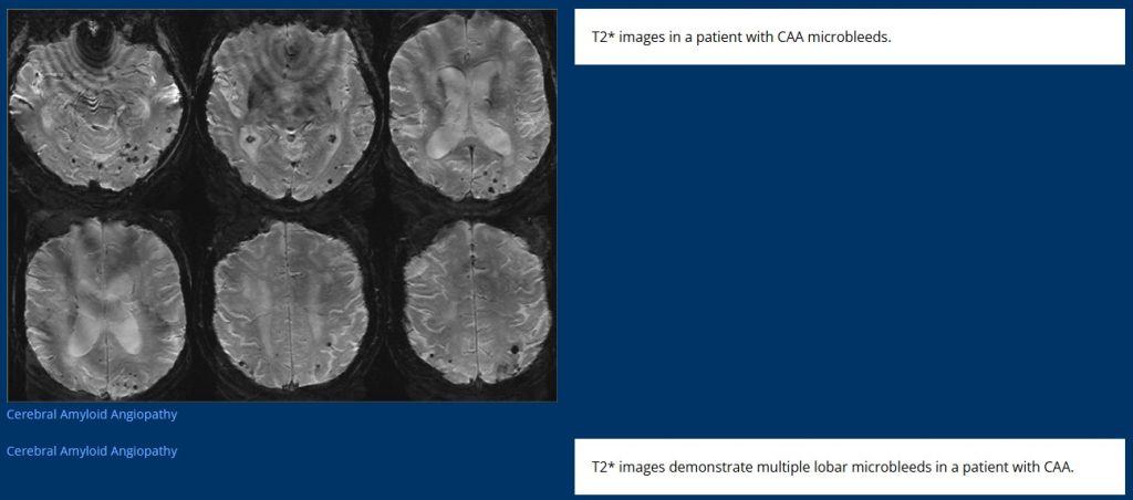 35 Frontotemporal Lobar Degeneration (FTLD)