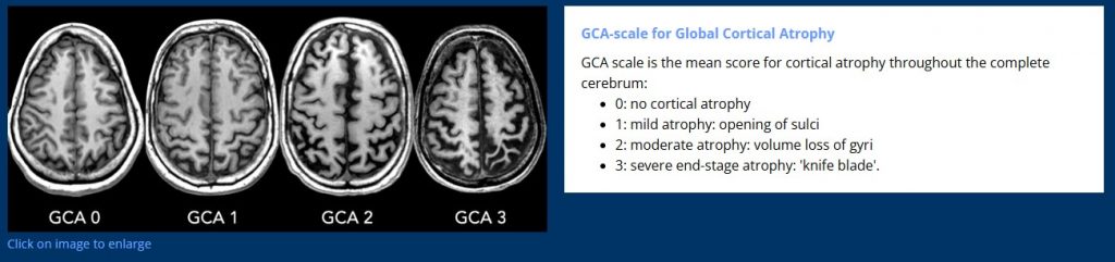 Cortical atrophy is best scored on FLAIR images.