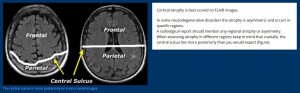 MTA-scale for Medial Temporal lobe Atrophy