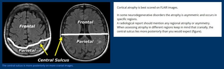 MTA-scale for Medial Temporal lobe Atrophy