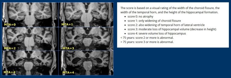 Here you can scroll through the images for examples of MTA score 0-4 ...