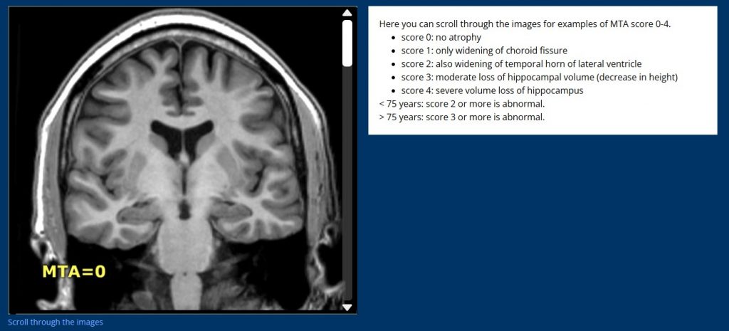 High MTA: Alzheimer’s vs. Other Dementias